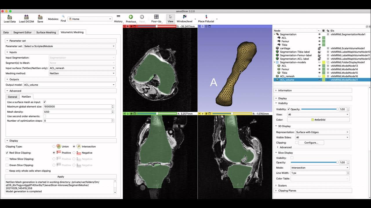 aeva: Femur-ACL-Tibia Tutorial - YouTube