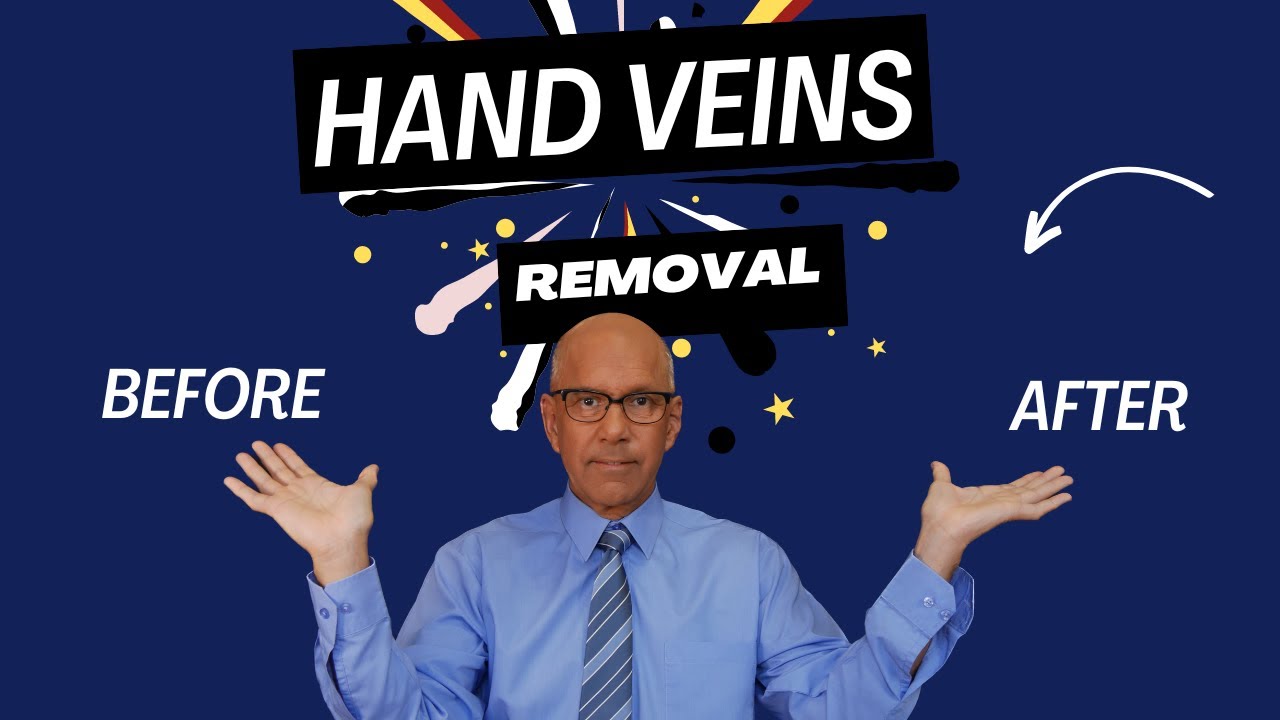 Hand Vein Removal by Sclerotherapy: Hand Vein Sclerotherapy Guide for ...
