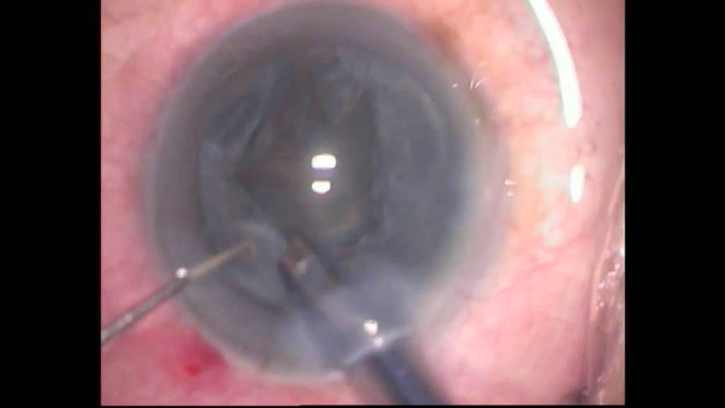 Multifocal Lens In Cataract Surgery By Dr Uday Gadgil Youtube
