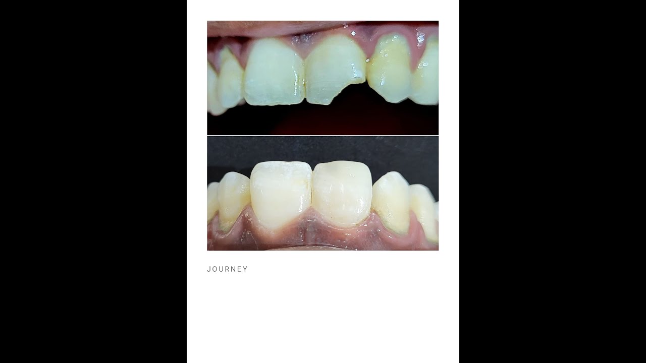 Recreate Broken Front Tooth - Restore Smile Again ! - YouTube