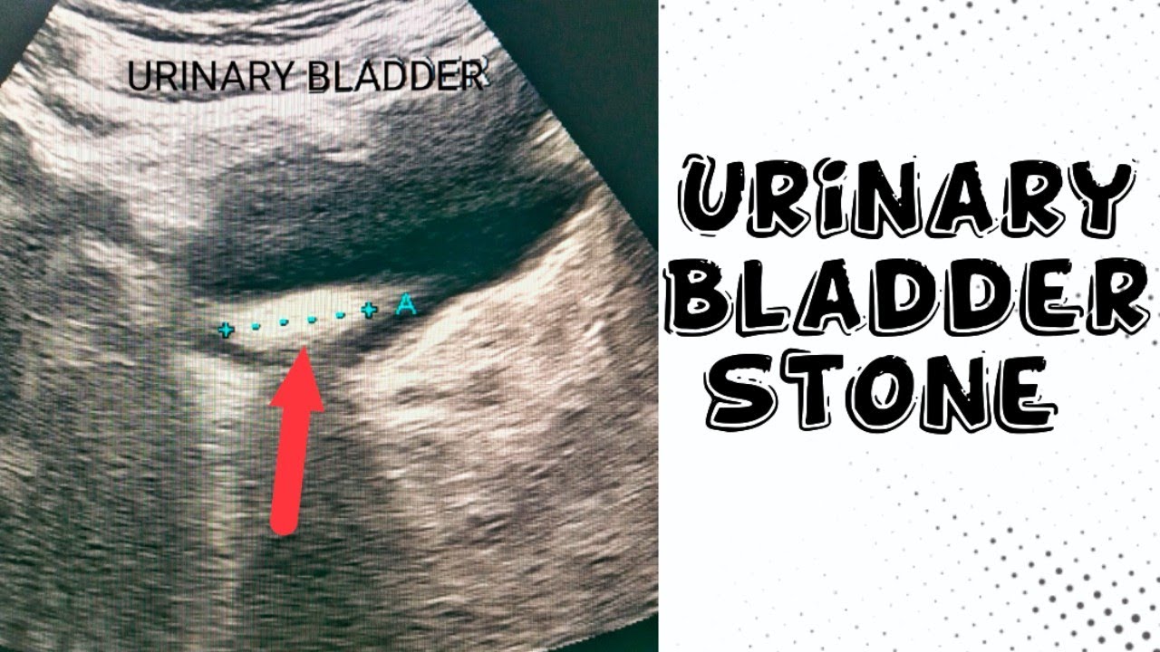 Urinary Bladder Stone | Urinary Stones | Ultrasound KUB - YouTube