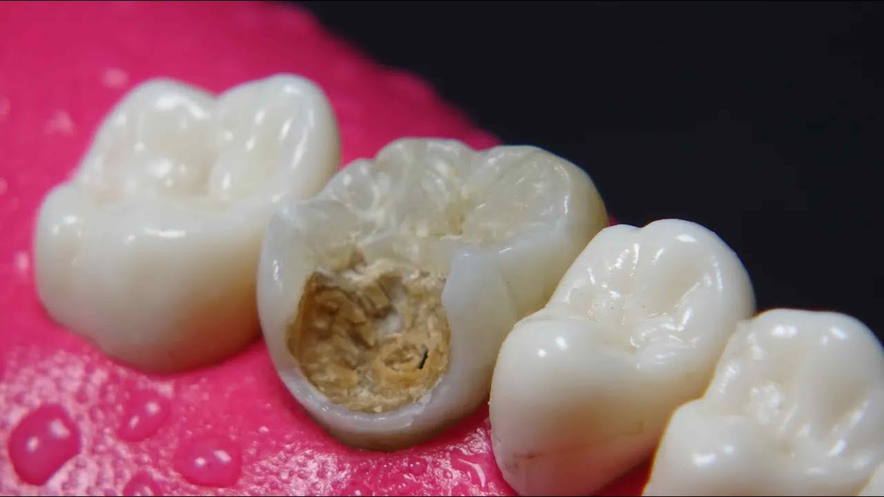 INCREIBLE dentista reconstruye diente dañado por caries: Endodoncia ...