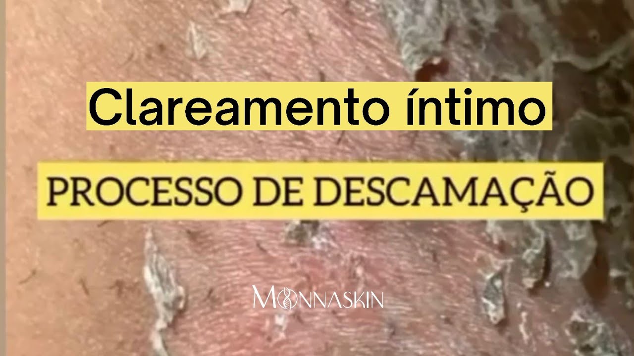 Tudo sobre o clareamento íntimo com peeling Monnaskin - YouTube