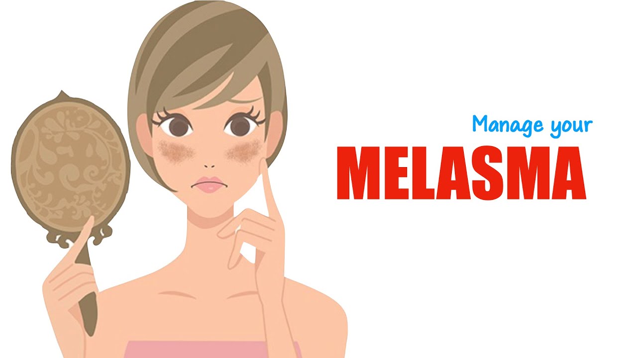 Melasma/Mask of pregnancy/Chloasma/Pigmentation on face/Brown spots ...
