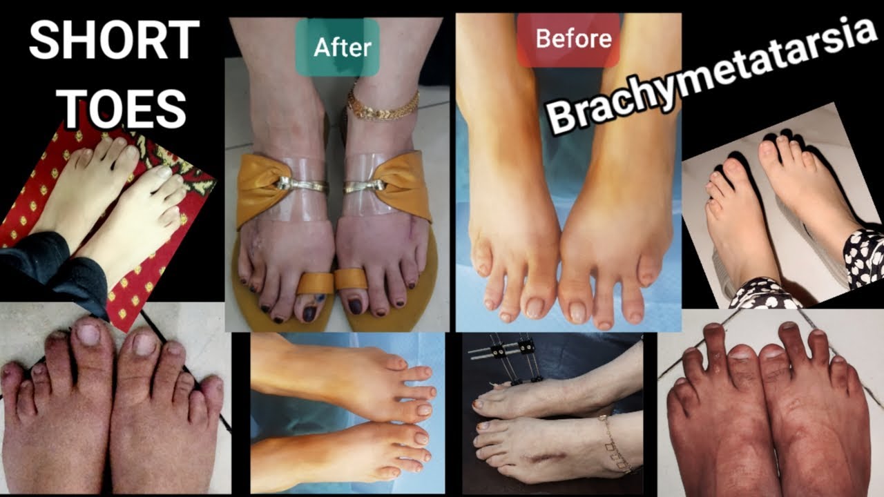 Life After Short toe lengthening /From Hesitation & Hiding to ...
