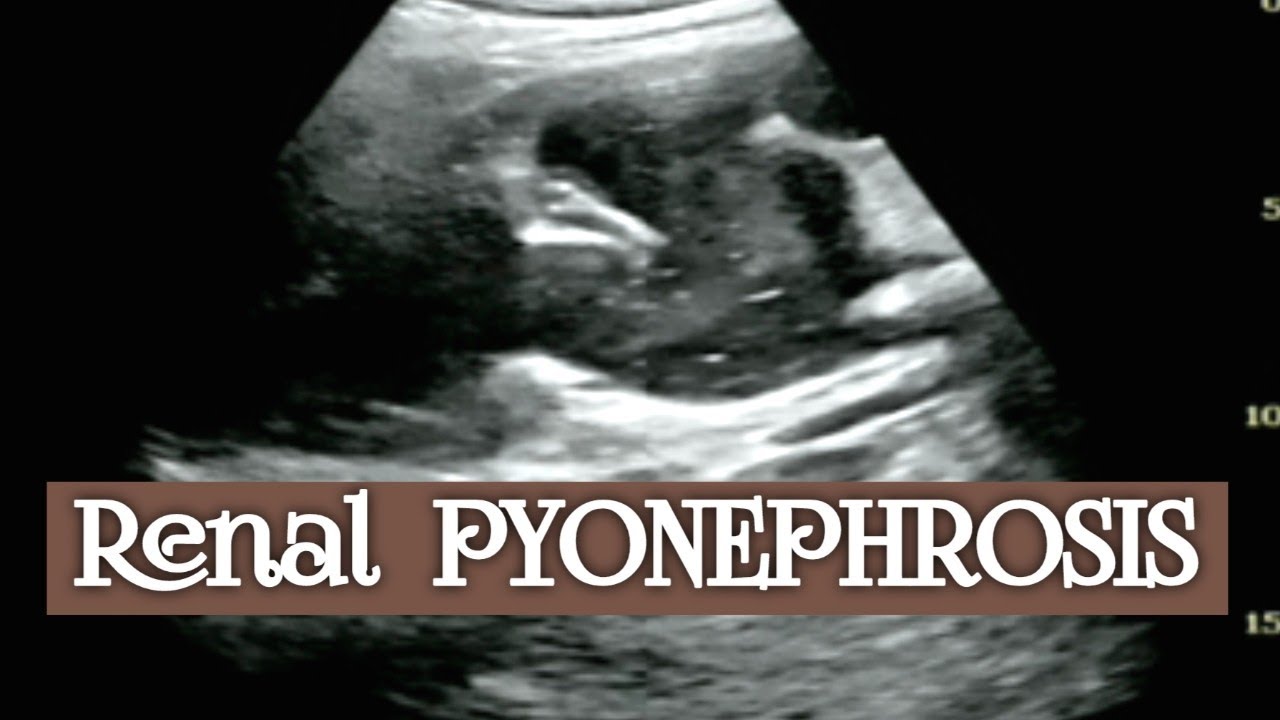 Ultrasound Pyonephrosis - Caused by Obstructed Stone - YouTube