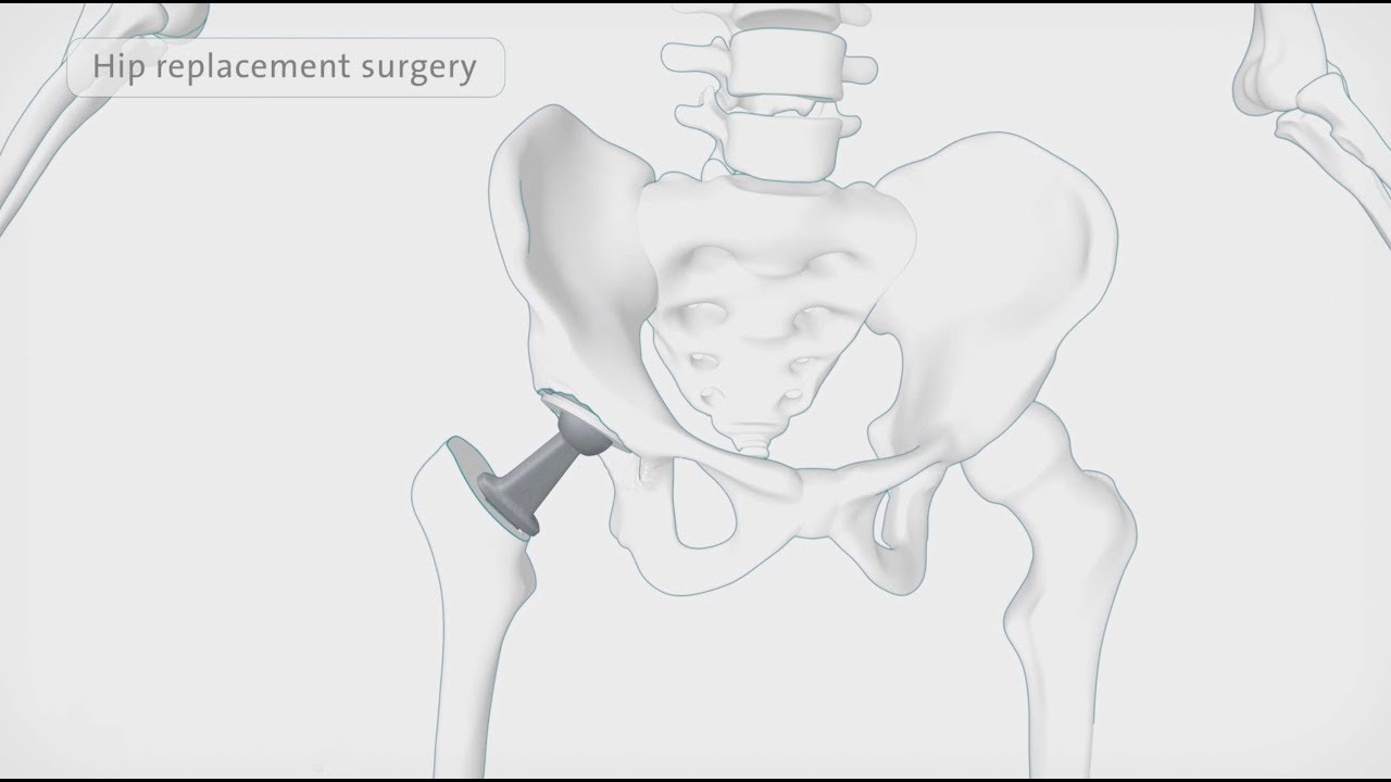 How a hip replacement is performed | Spire Healthcare - YouTube