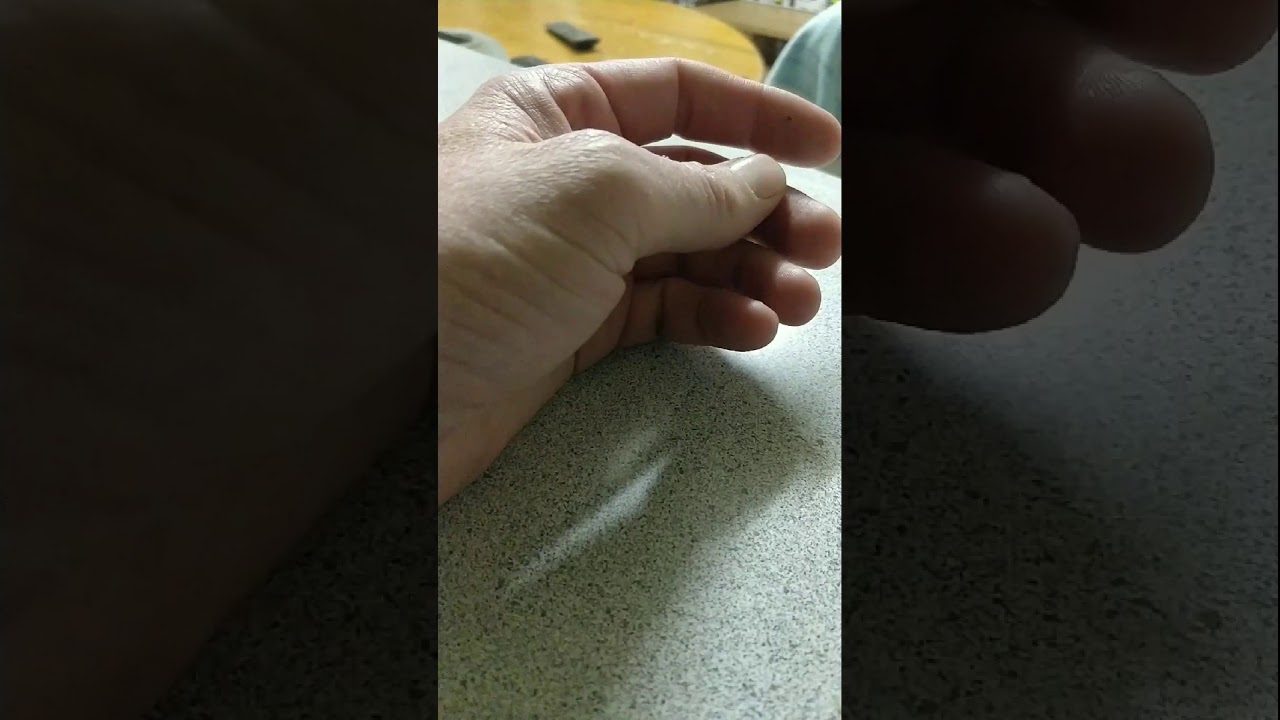 Cramp Fasciculation Syndrome intermittent finger twitches - YouTube