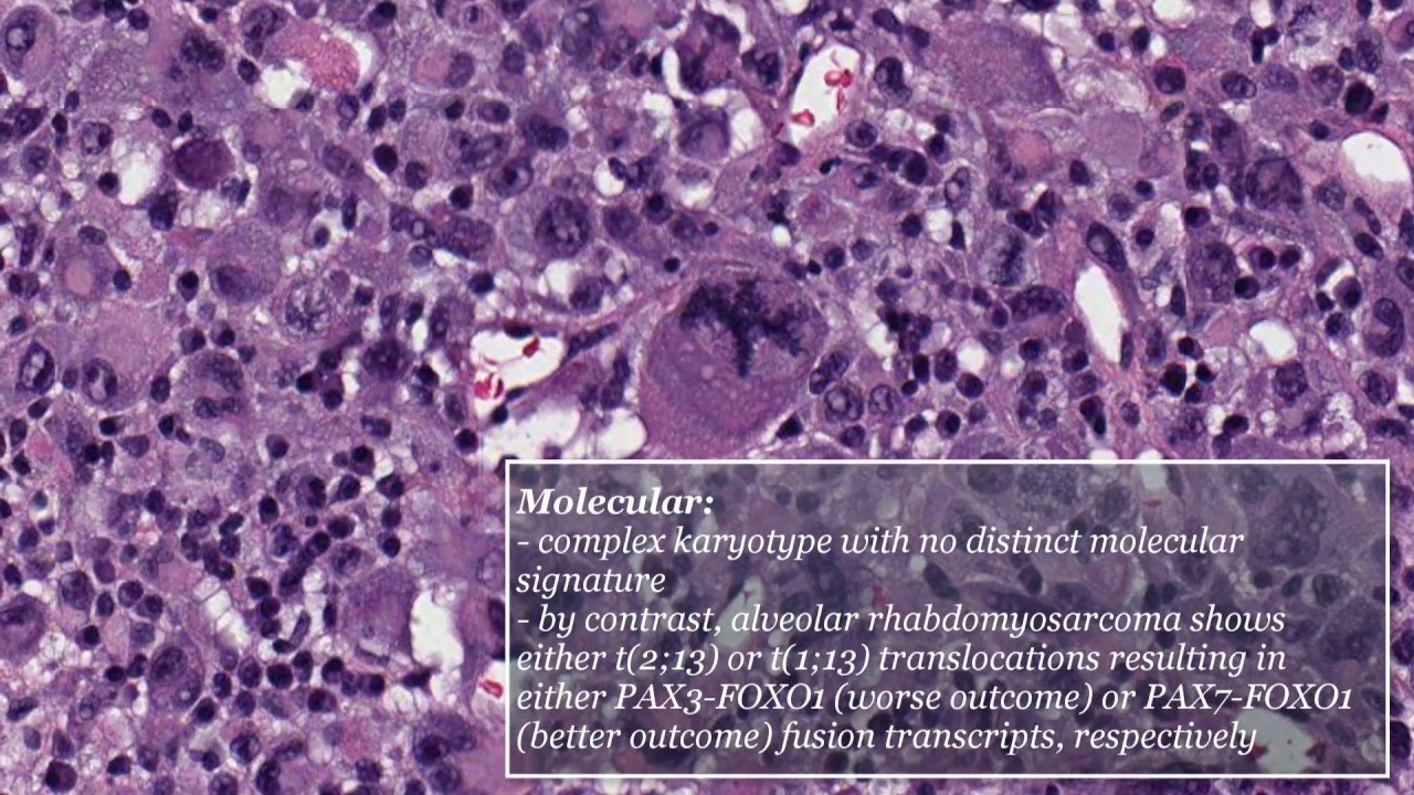 Pleomorphic Rhabdomyosarcoma - YouTube