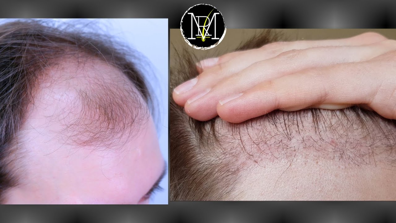 3500 Grafts 14 Weeks Result FUE Hair Transplant YouTube 3500-grafts-14-weeks-result-fue-hair-transplant-youtube