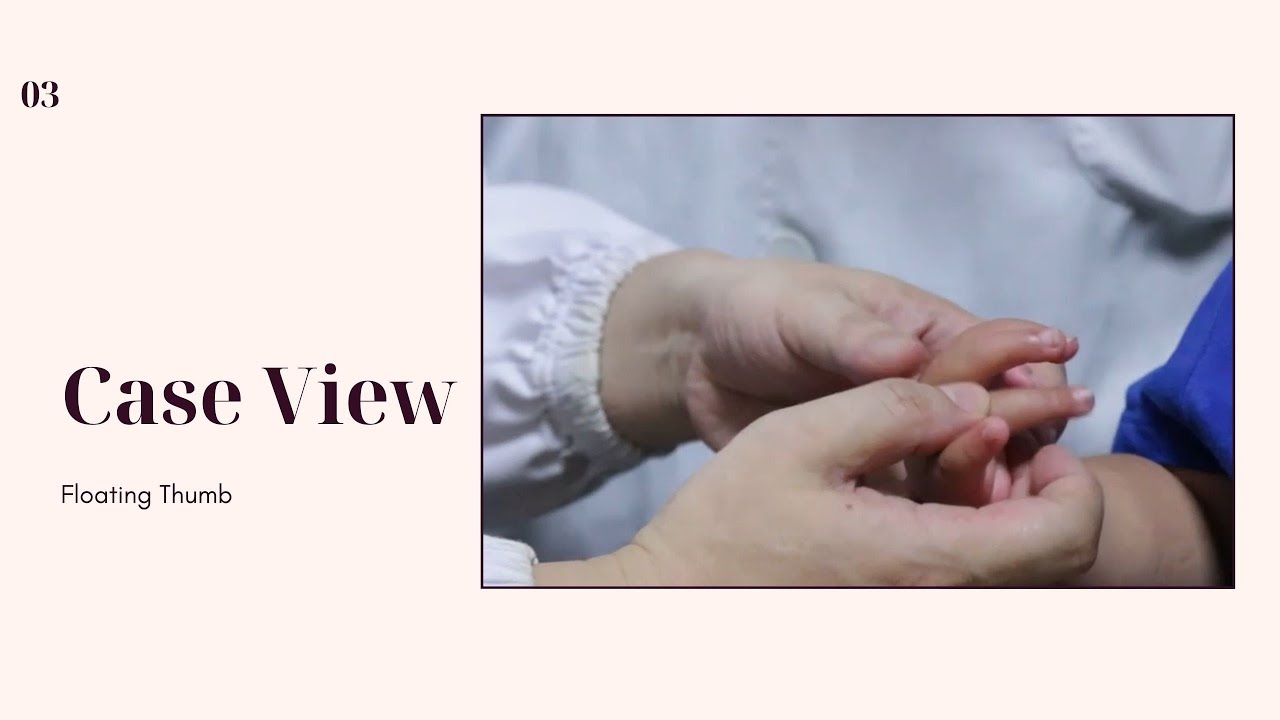 Surgical Planning with a Floating Thumb Patient - YouTube