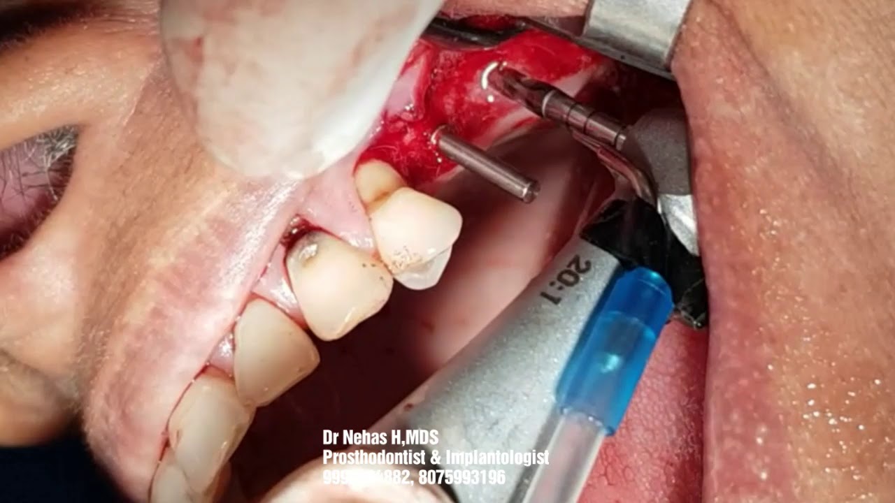 Indirect Sinus lift and Ridge expansion with Densah burrs - YouTube