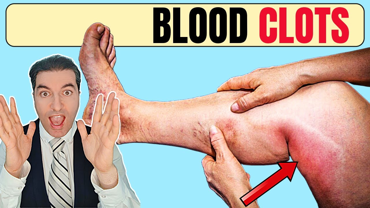 Blood Clot Signs: Brain, Legs, Heart, Lungs + Natural Remedy - YouTube