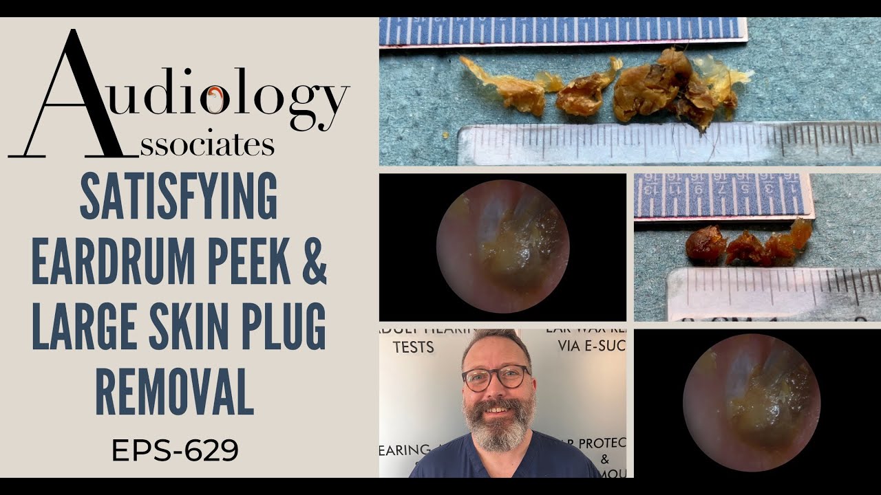 SATISFYING EARDRUM PEEL & LARGE SKIN PLUG REMOVAL -EP629 - YouTube
