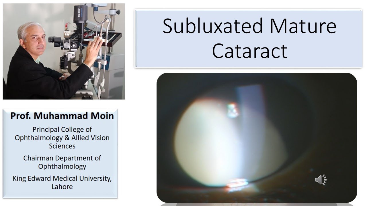 Subluxated Mature Cataract Surgery Options - YouTube