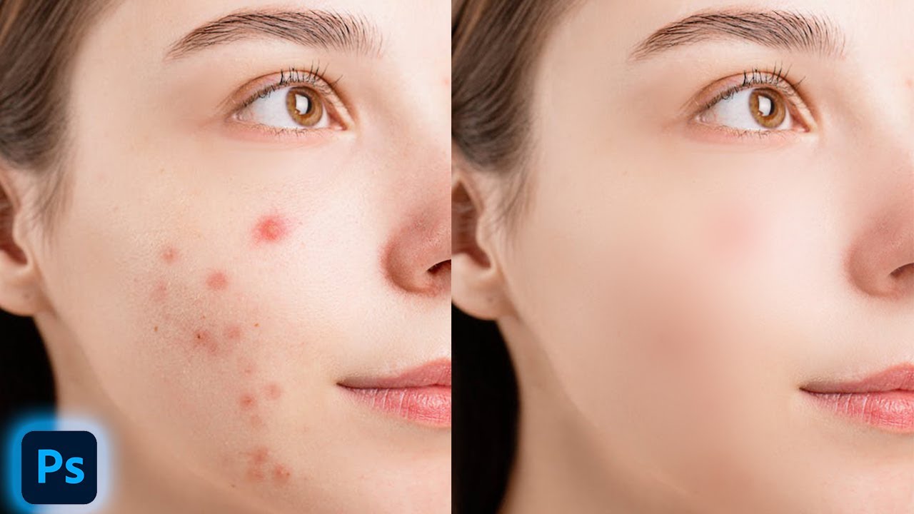 How to Remove Acne and pimples in photoshop/ Photoshop Retouching ...