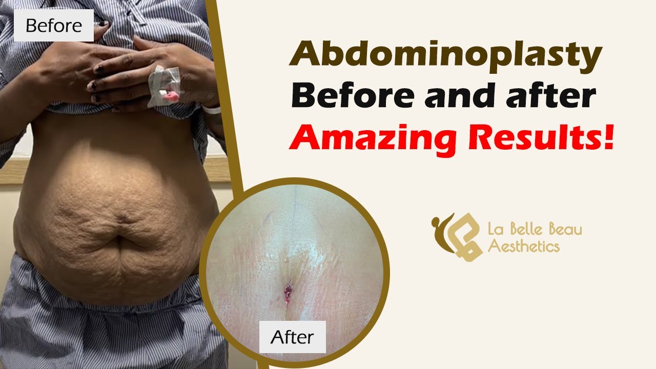 Abdominoplasty Procedure- Before & After - YouTube
