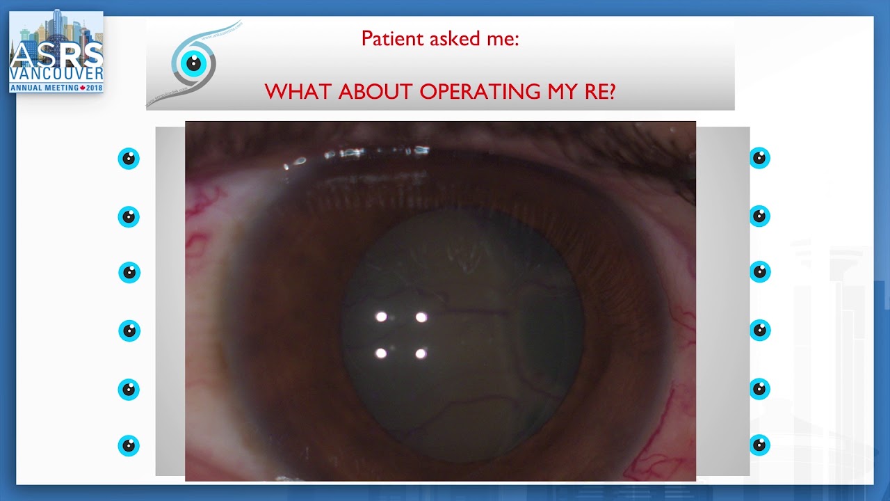 Nanophthalmus retinal detachment Scleral Window surgery - YouTube