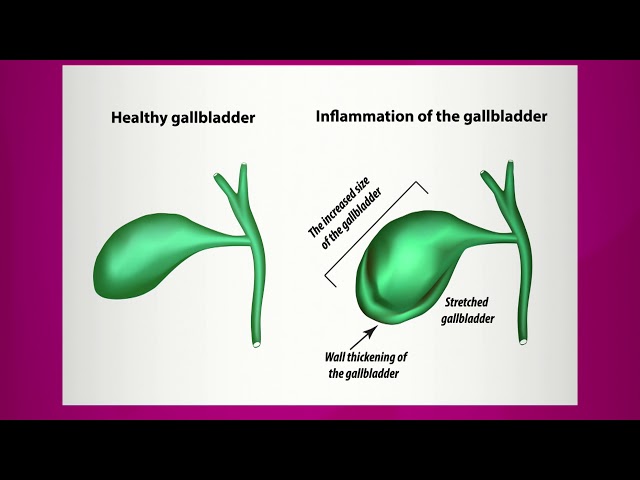 Inflamed Gallbladder Symptoms How Is Cholecystitis Diagnosed And