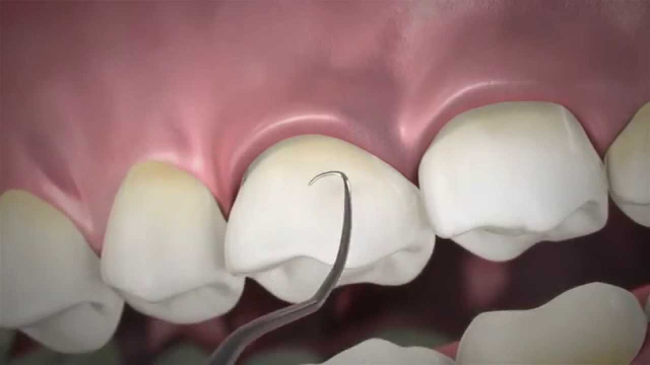 Ligosan Video dimostrativo sull'applicazione del prodotto - YouTube