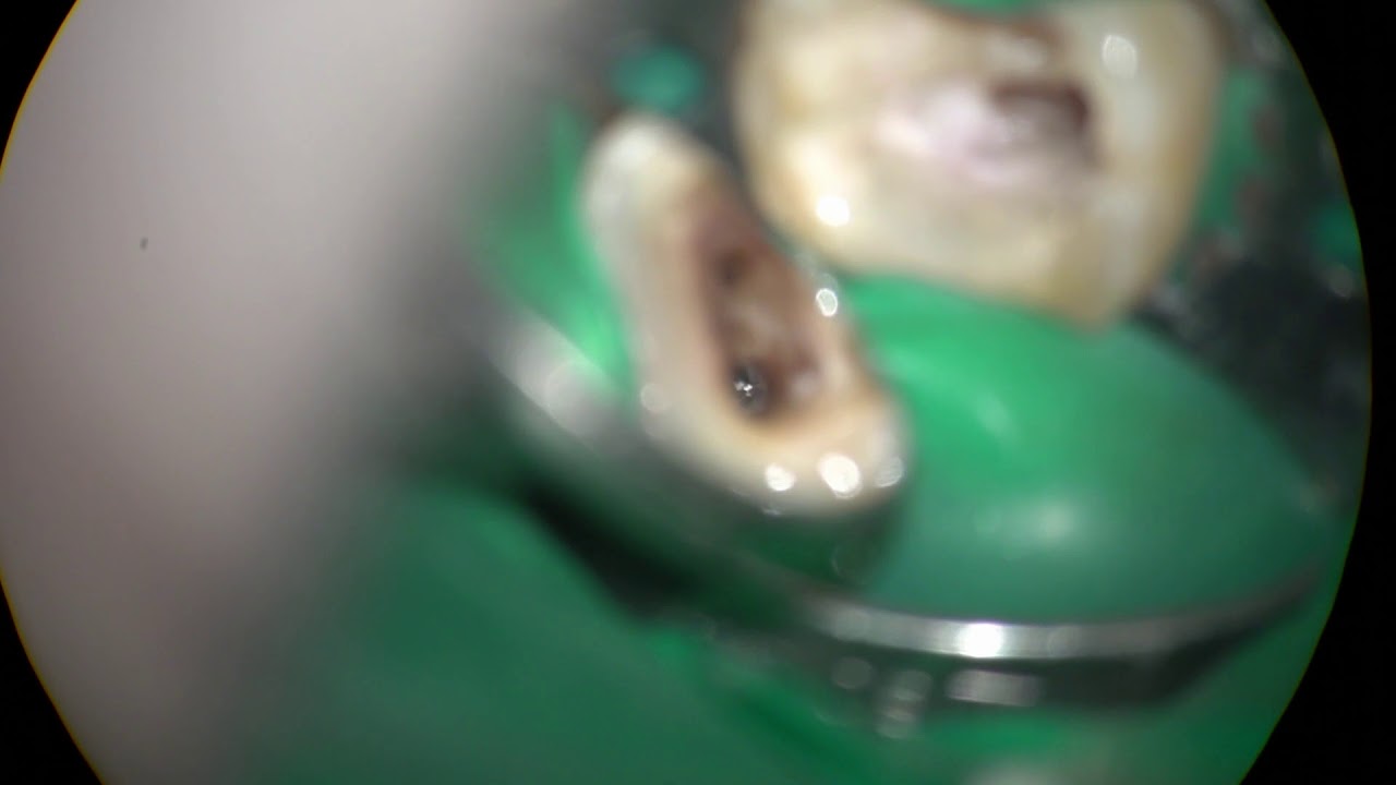 new broken file removal technique - YouTube