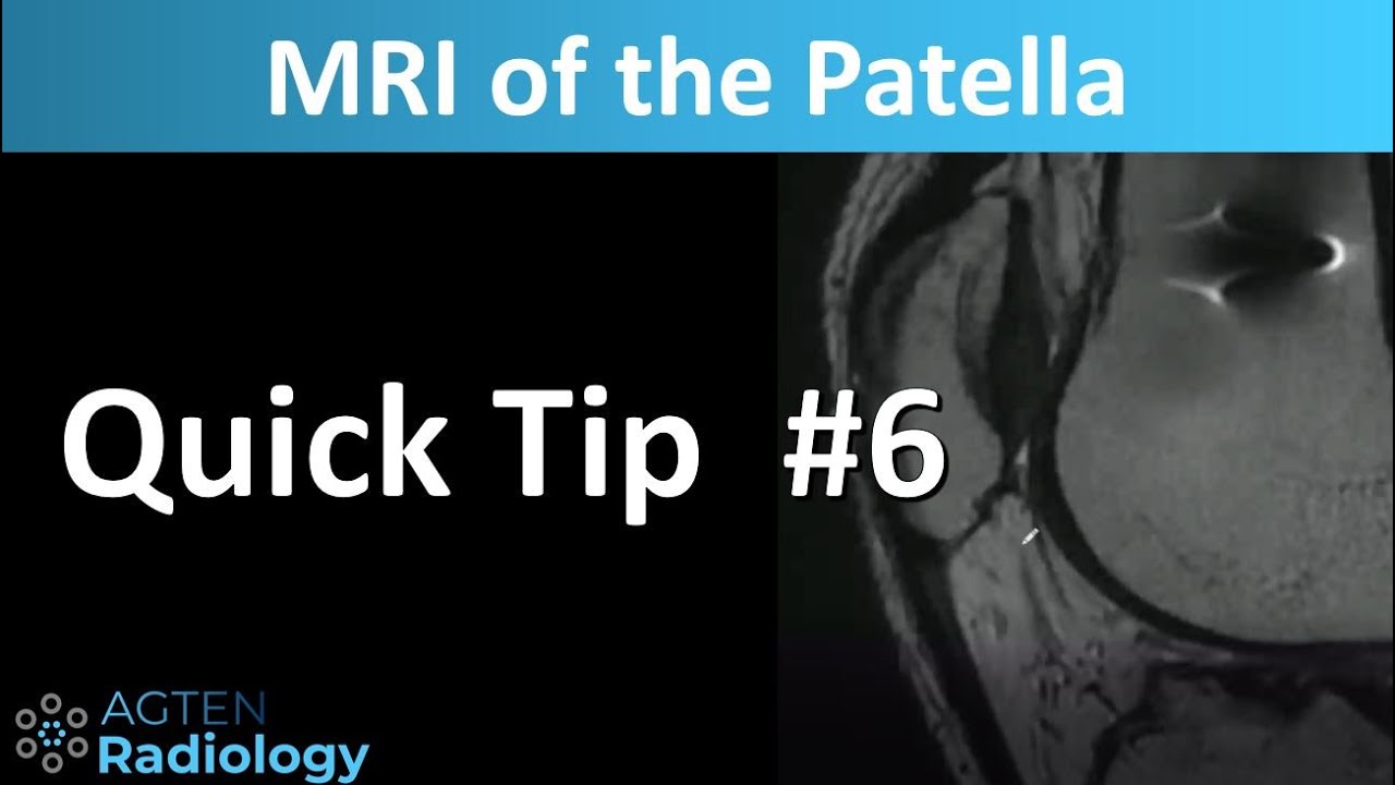 MRI of the Patella: The Patellar Calcar - YouTube