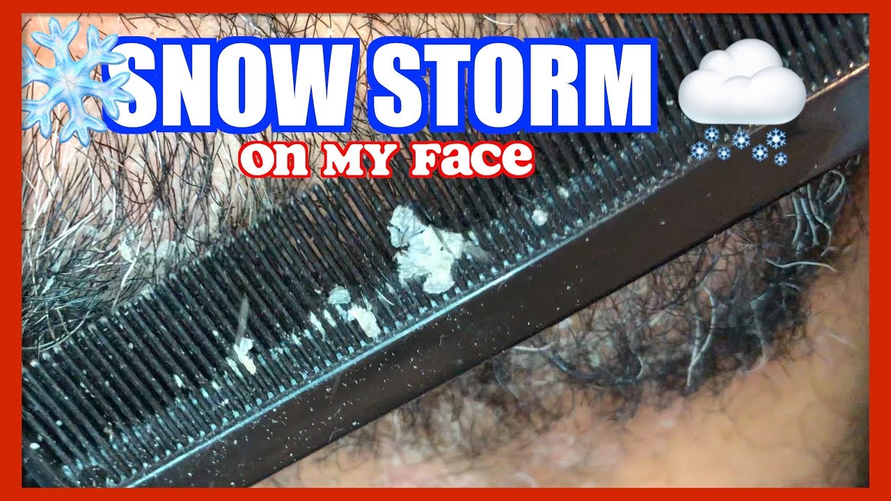 Face The Flakes | Eyebrows And Beard Dandruff - YouTube