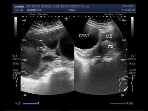 Ultrasound Video showing a large multi-septic ovarian Cyst. - YouTube