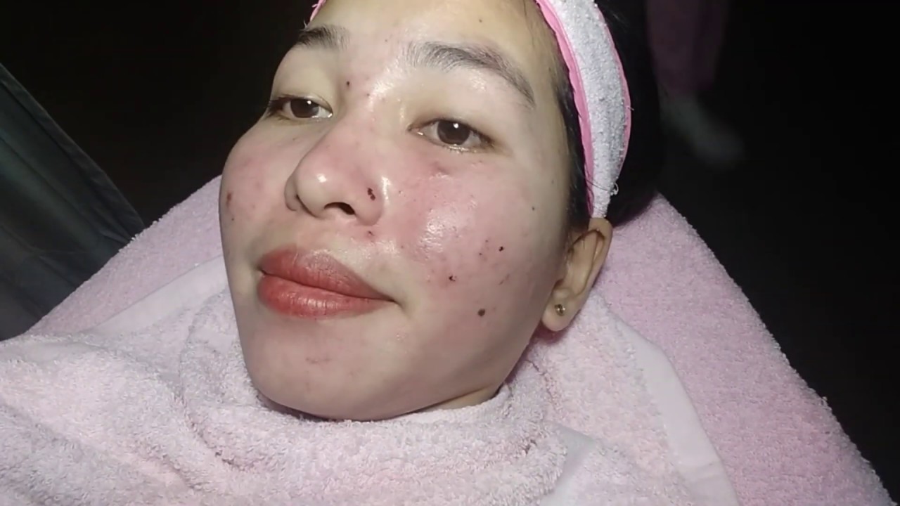 Acne Treatment | Marine Mud Facial at Surgilight Aesthetic Center - YouTube