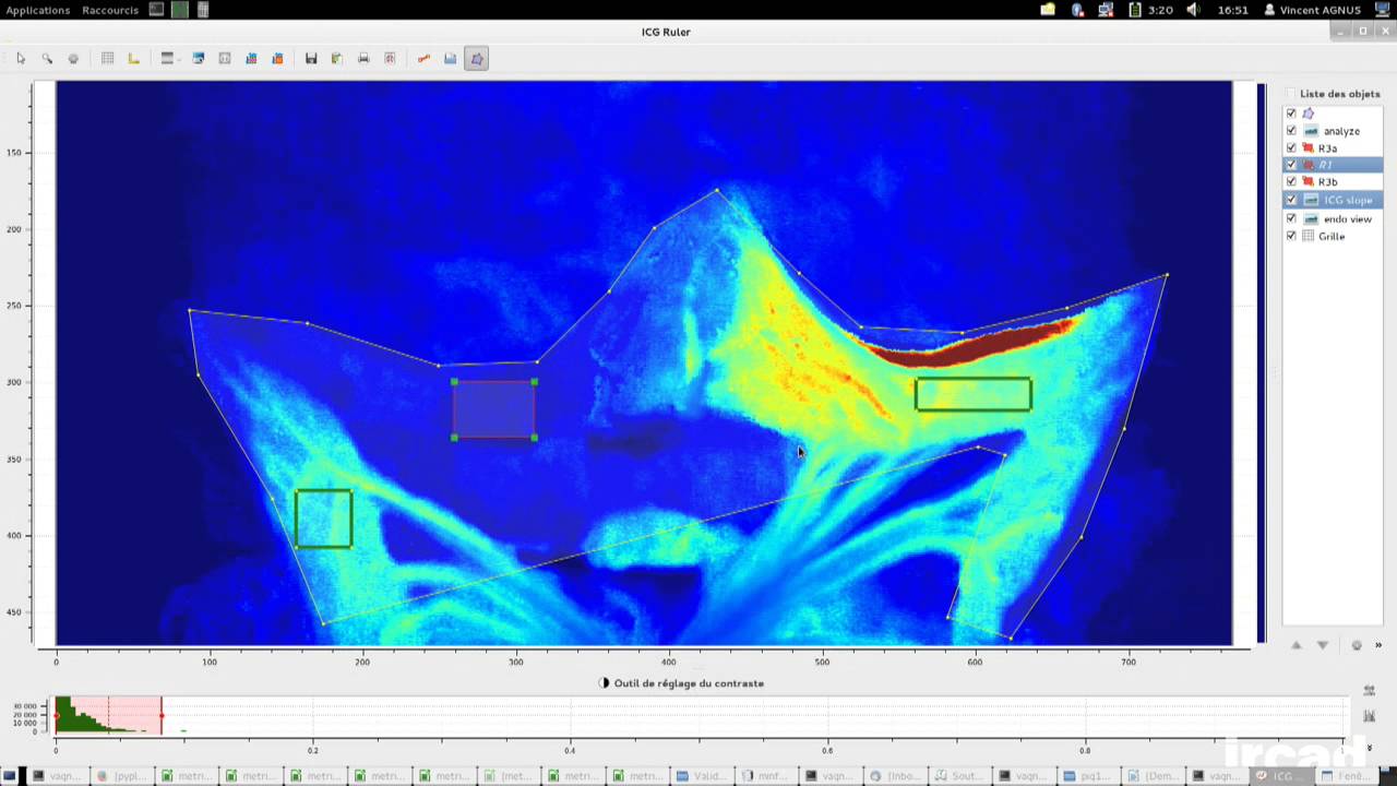 Fluorescence based enhanced reality for intraoperative assessment of ...