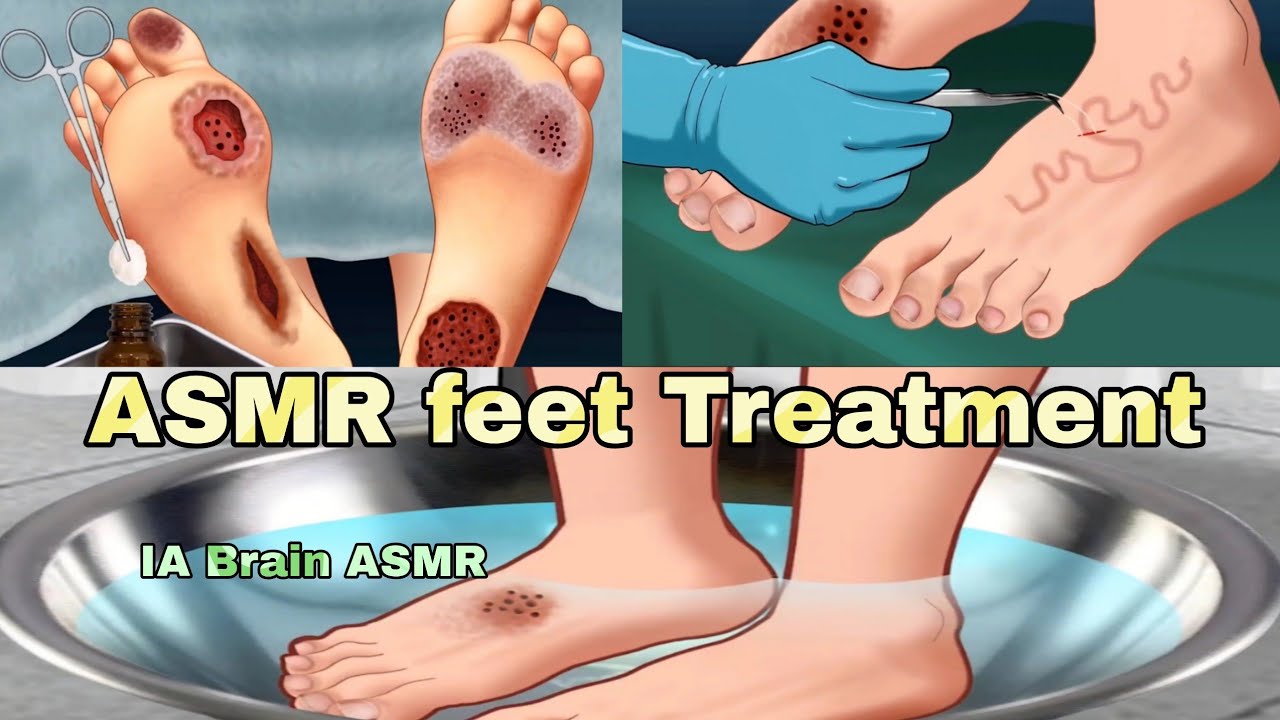 ASMR Treatment infected parasitic wounds and remove snails disinfect ...