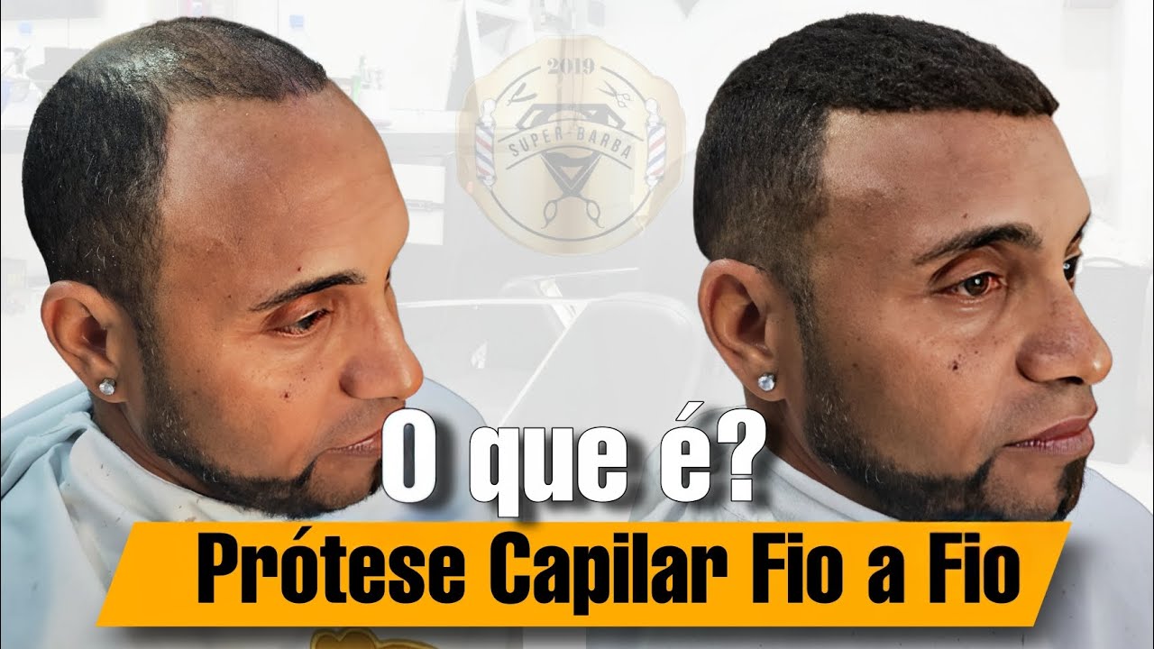 O que é prótese capilar Fio a Fio? - YouTube