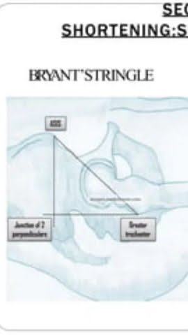 Bryant triangle #orthopedics - YouTube