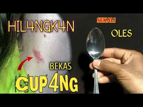 REMAJA WAJIB TAU !!! Cara Cepat Menghilangkan Bekas Cupang Di Leher