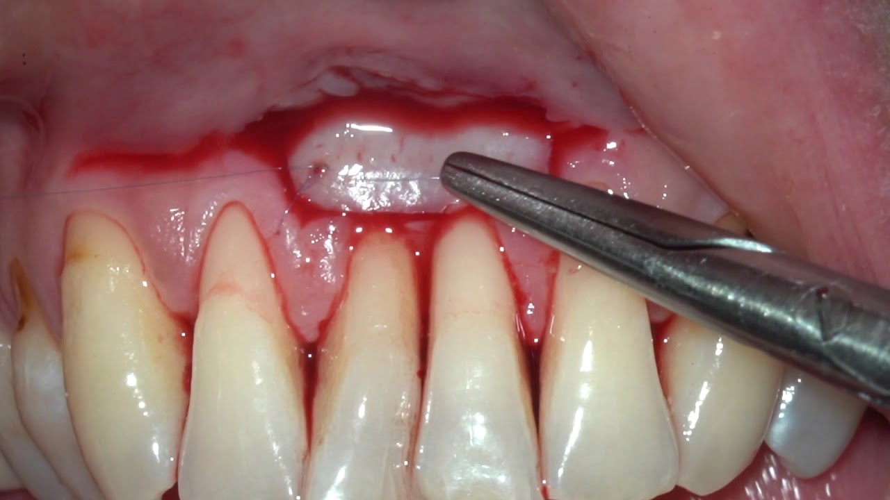 Free gingival graft and frenotomy - YouTube