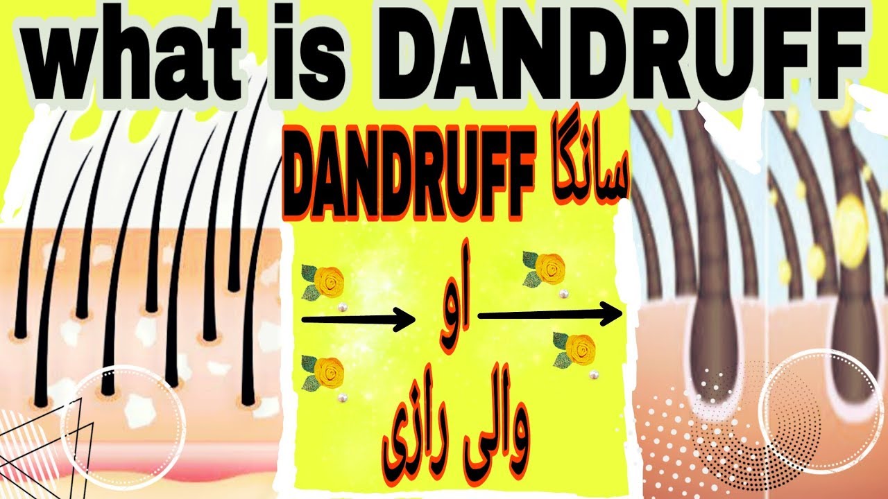 WHAT IS DANDRUFF AND HOW TO TREAT DANDRUFF (SCIENTIFIC ANIMATION FACT ...