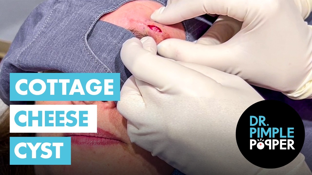 Cottage Cheese Cyst - YouTube