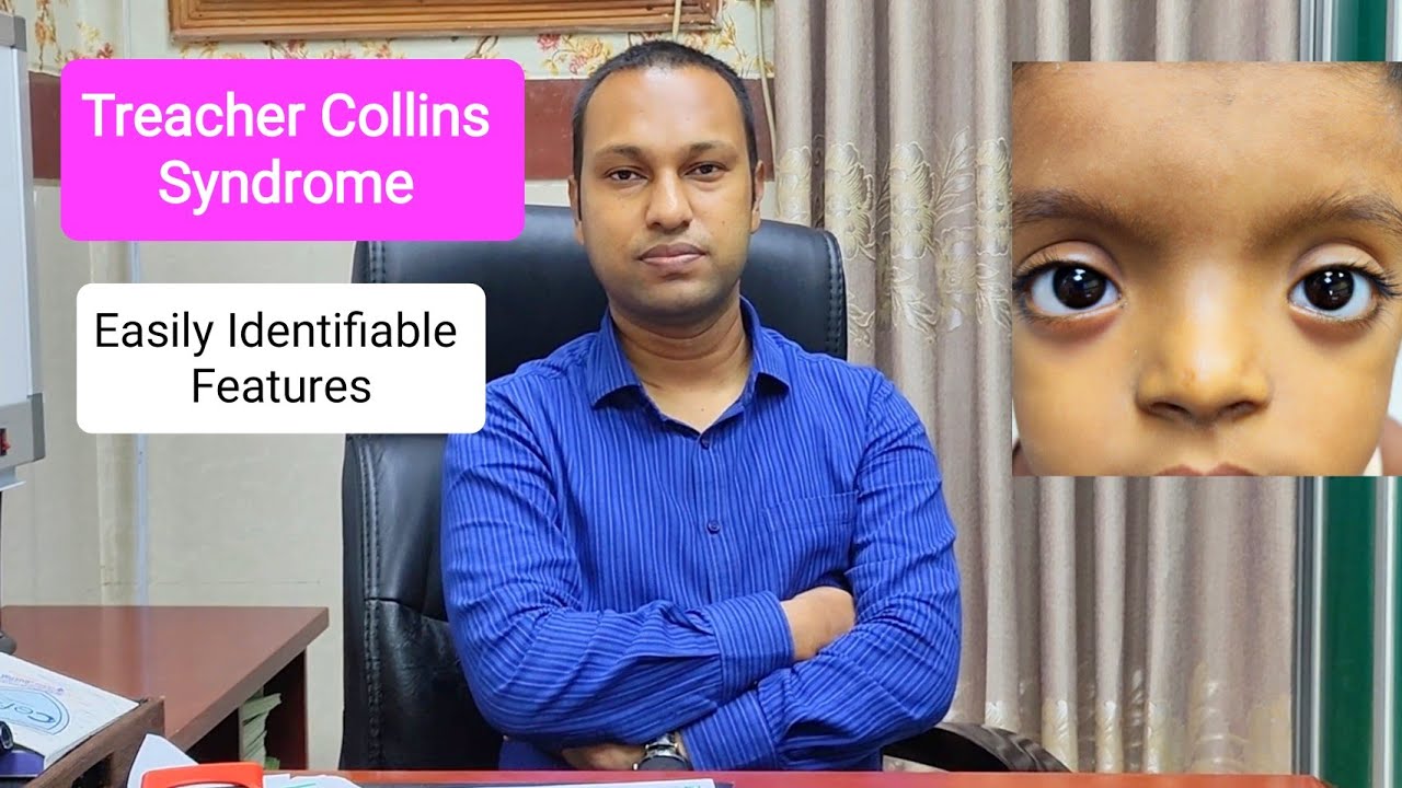 Treacher Collins Syndrome: Learn Easily Identifiable Features - YouTube