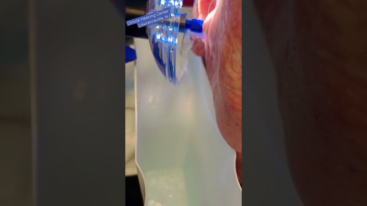 Ear wax removal with the Earigator was so fast today! - YouTube