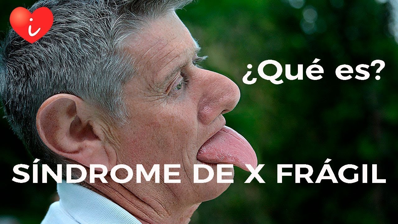 ¿Qué es el Síndrome de X Frágil? - InfoFamily - YouTube