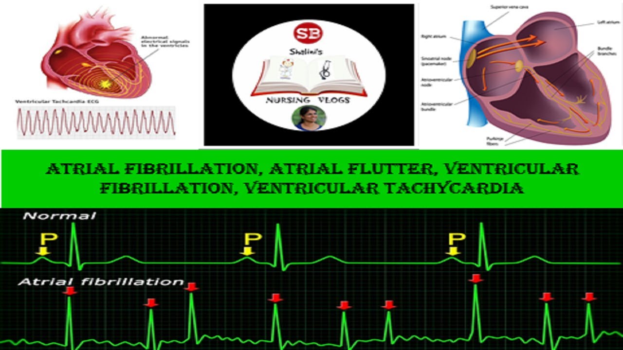 Ventricular Flutter