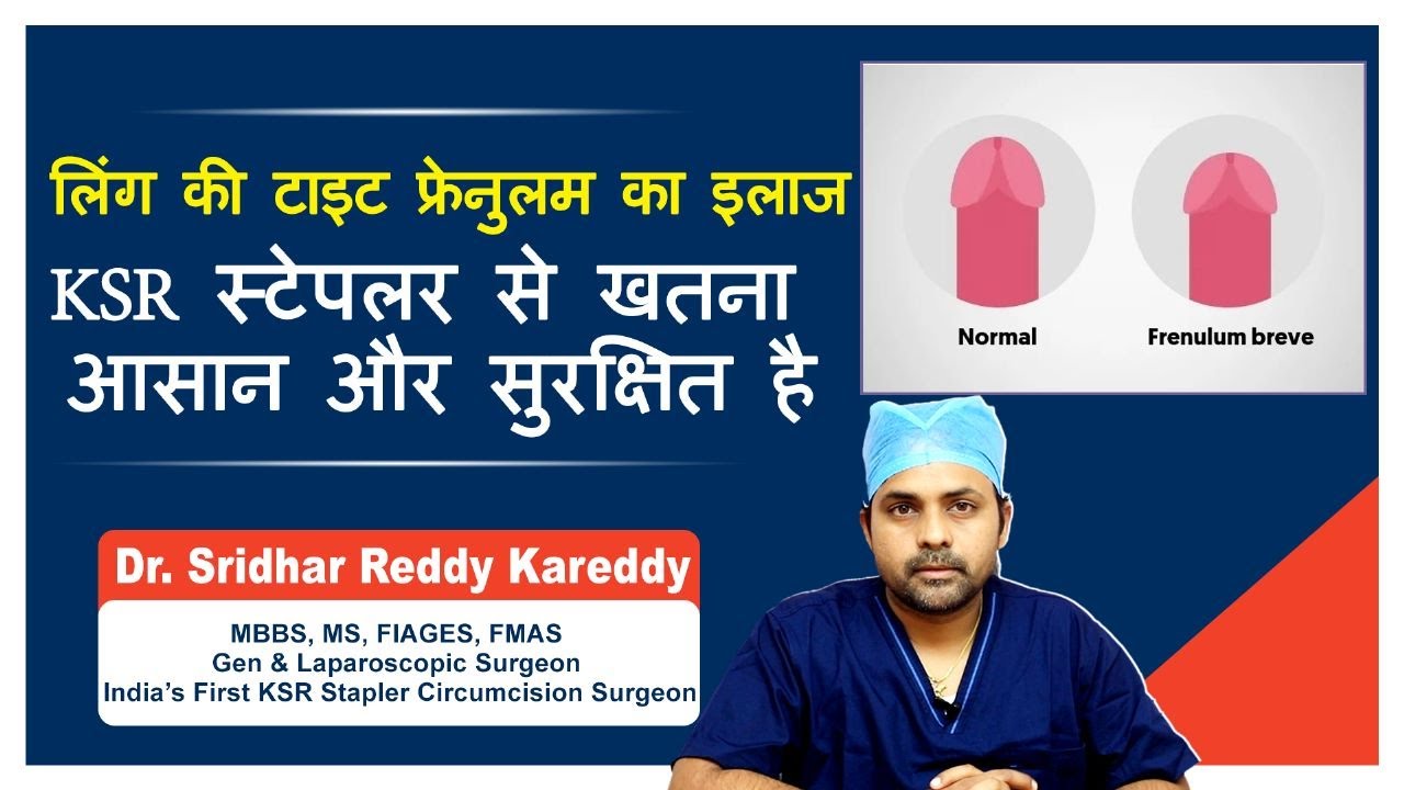 टाइट फ्रेनुलम का इलाज | Treatment for Tight Frenulum | KSR Stapler Circumcision | Circum Cure ...