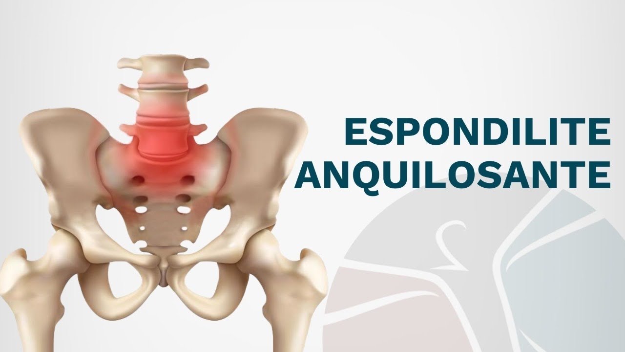Espondilite Anquilosante Espinha De Bambu