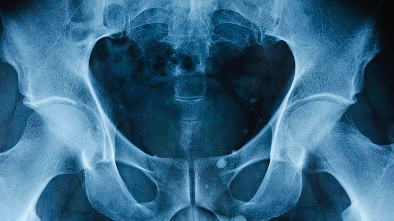 PUDENDAL NERVE BLOCK - YouTube