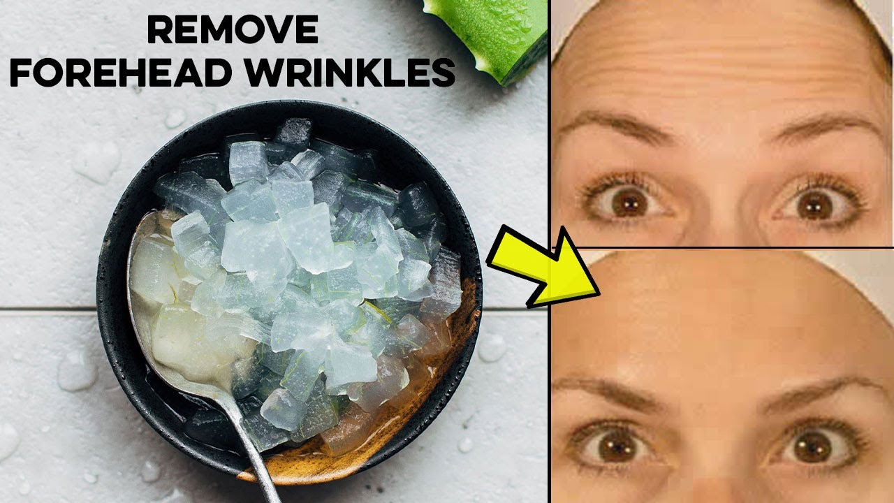 How To Get Rid Of Forehead Wrinkles Naturally - 5 Home Remedies to ...