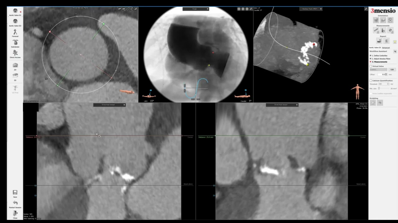3Mensio CT pre-case planning: TAVR in Bicuspid Valve, Part 2 - YouTube