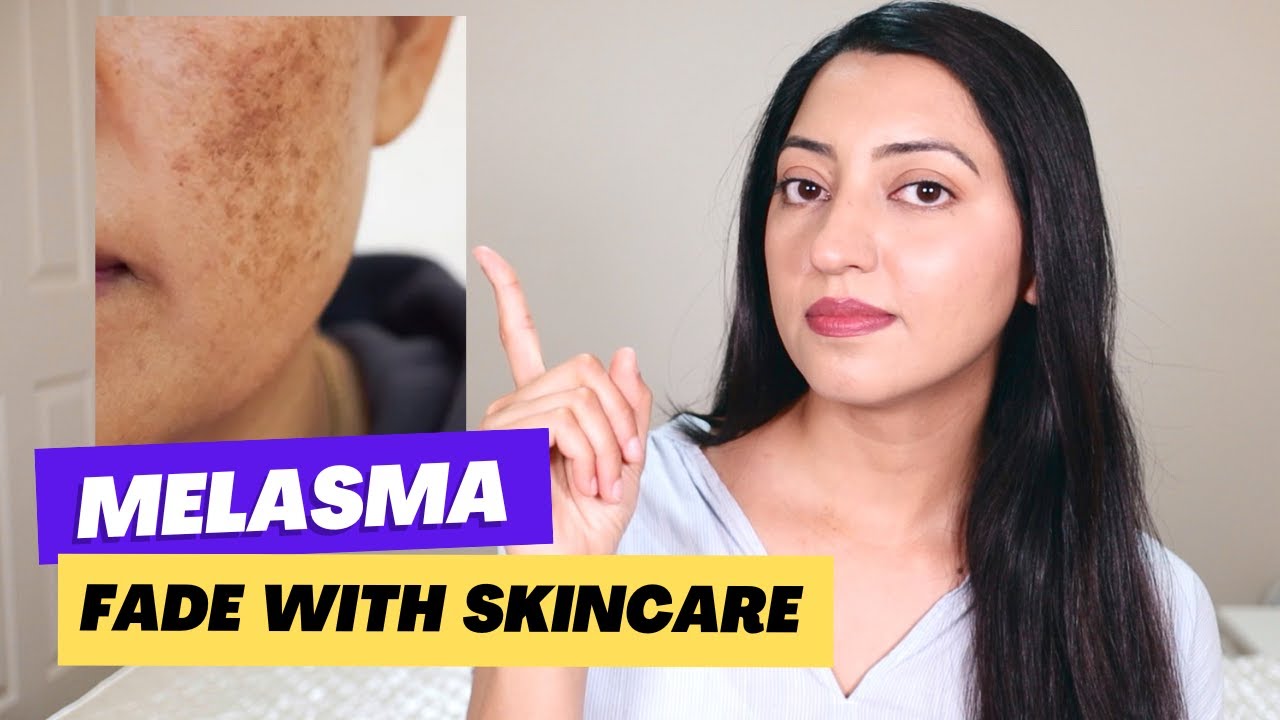 How to Remove Melasma, Pigmentation with Skincare - YouTube