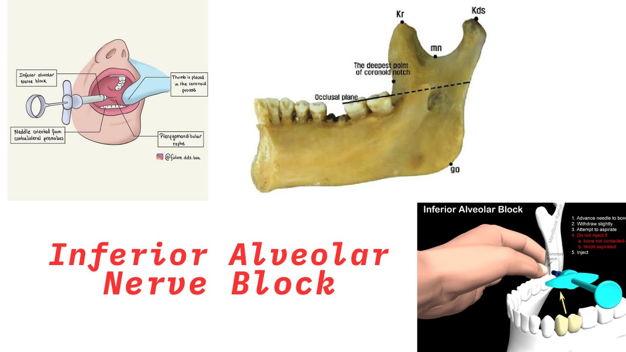 INFERIOR ALVEOLAR NERVE BLOCK: BY DR PRIYANKA PANDEY - YouTube