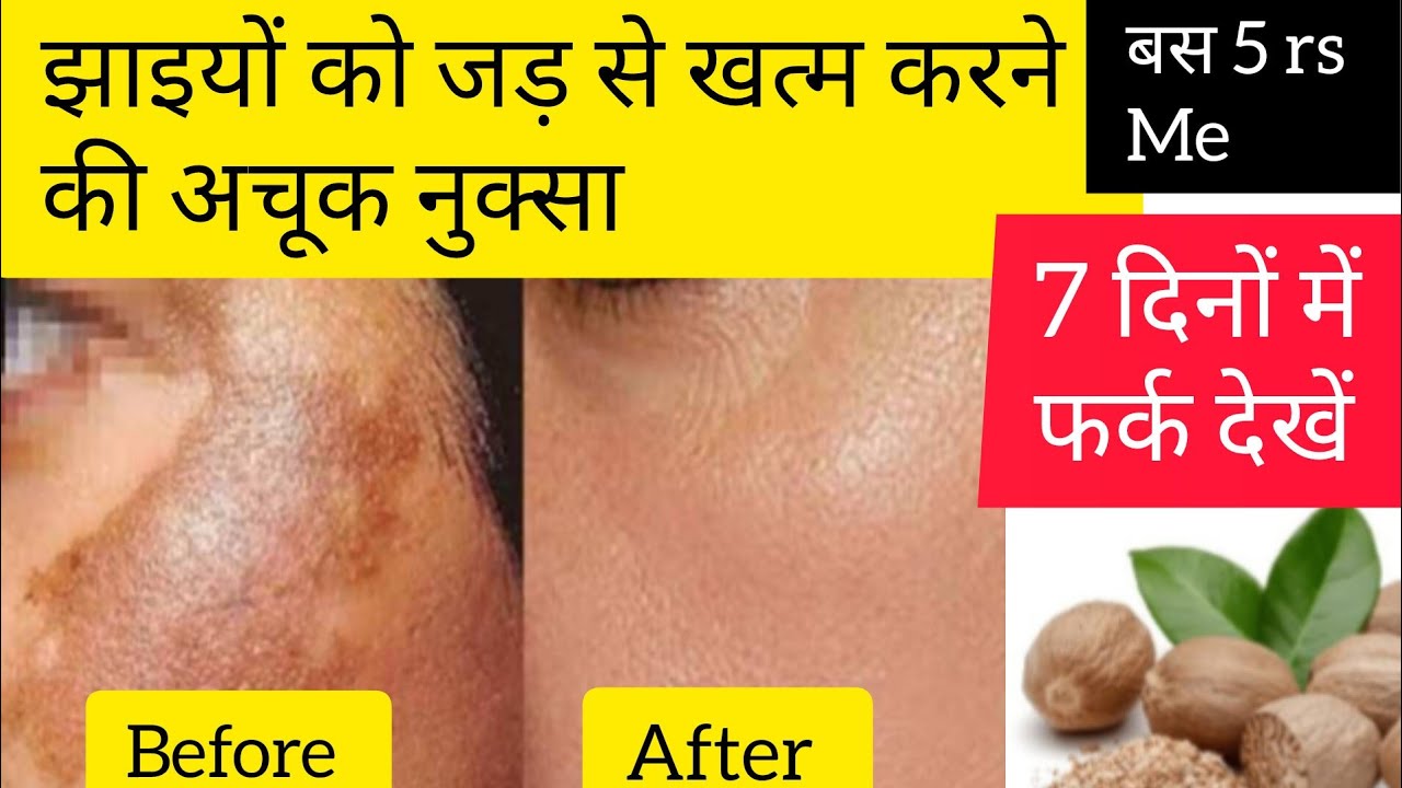 झाइयों से जड़ से राहत पाएं।। hyper pigmentation homeopathy medicine ...