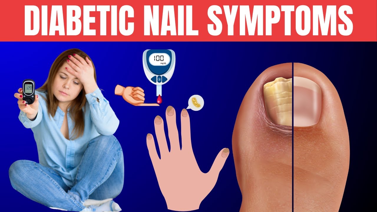 5 Signs of Diabetes on Your Nails - YouTube